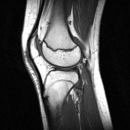 ABC Radiology Blog: Fabella