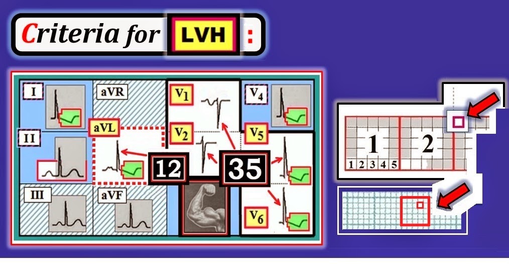 ECG Interpretation: ECG Blog #92 (Basic Concepts-5) – LVH