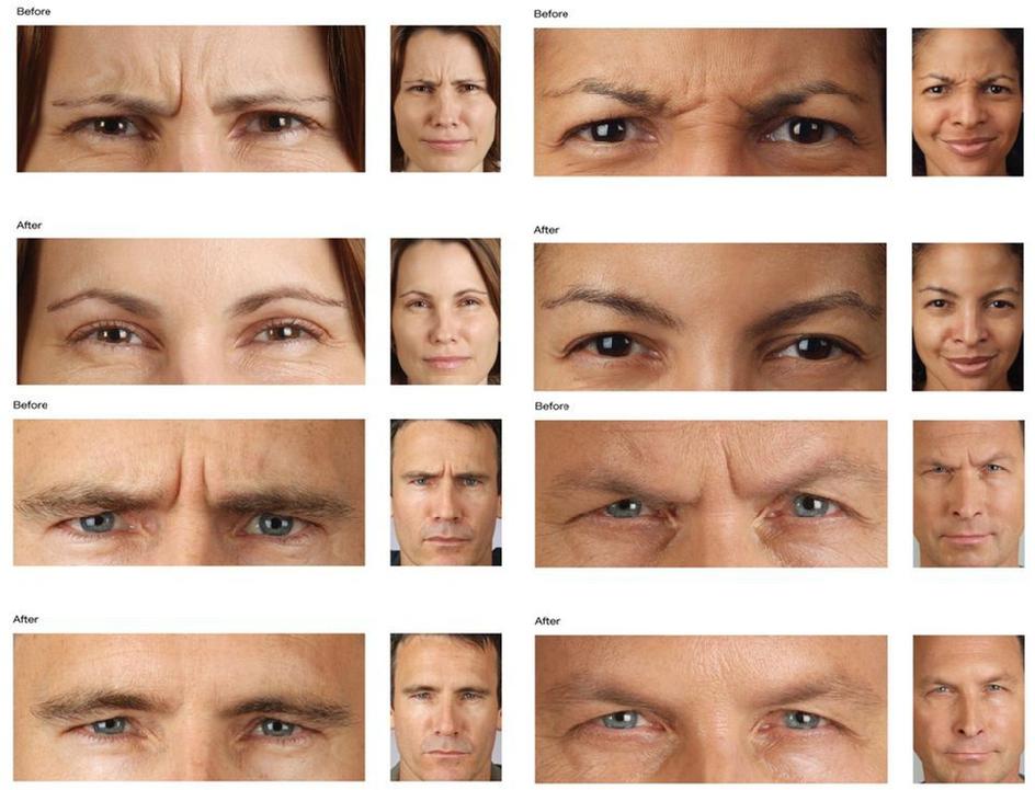 Toxina Botulínica y las lineas de expresión