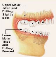 Omni Dental Group: Uprighting Tilted Molars