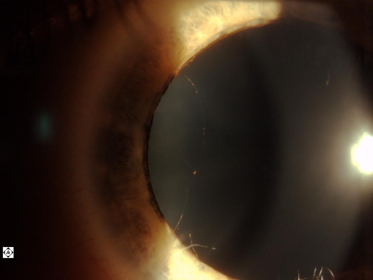 Sonoran Desert Eye Center: IRIS STRANDS