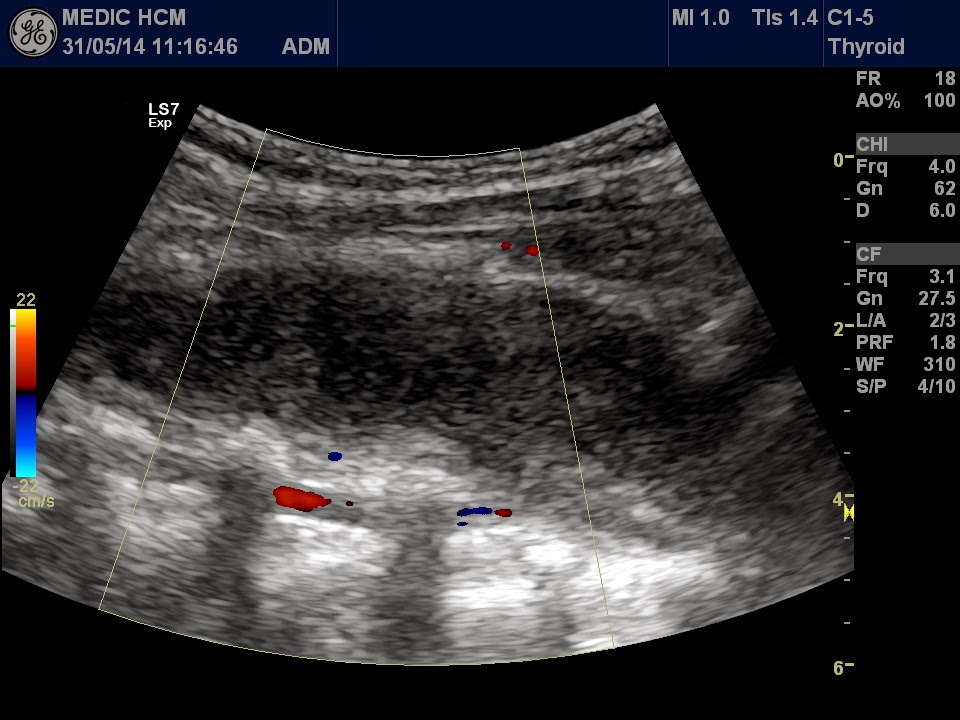 VIETNAMESE MEDIC ULTRASOUND: CASE 290: PARACERVICAL SPINE ABSCESS: Dr ...
