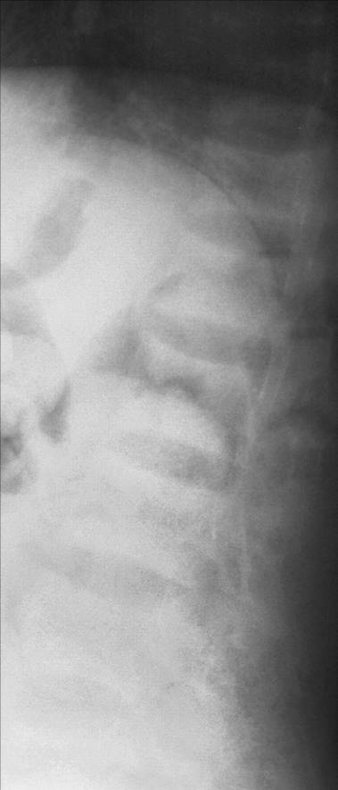 ABC Radiology Blog: The Rugger Jersey Spine Sign