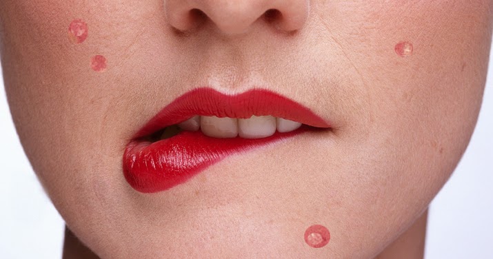 French Vocabulary Illustrated: bouton (pustule)