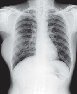 Study Medical Photos: A Lipoma On The Chest Wall