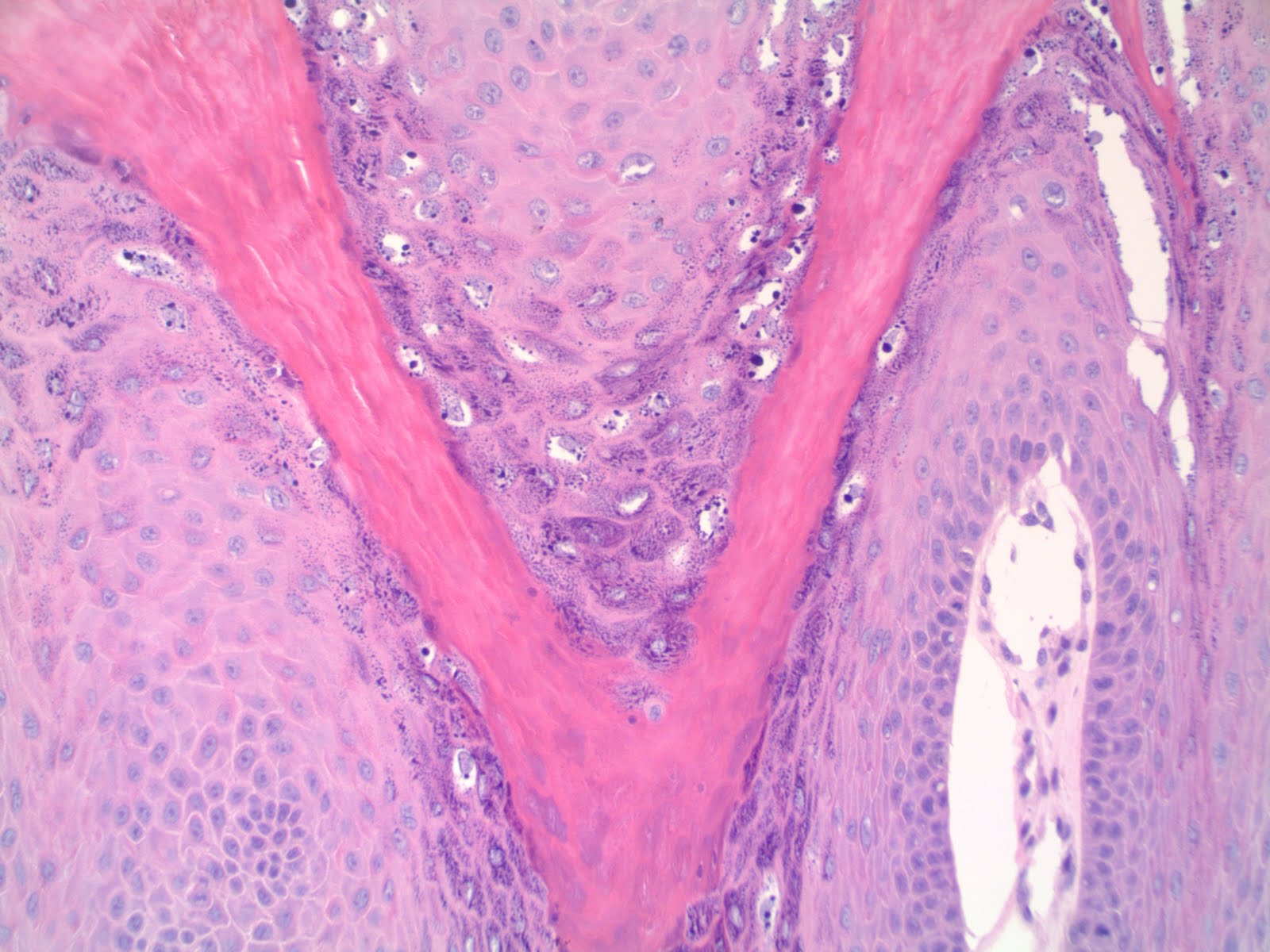 Dermatopathology: Verruca vulgaris