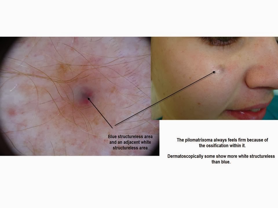 Dermpath Made Simple - Neoplastic: Pilomatrixoma