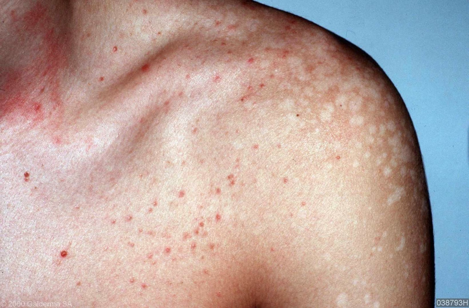 SKIN DISEASE TYPES: Tinea Versicolor