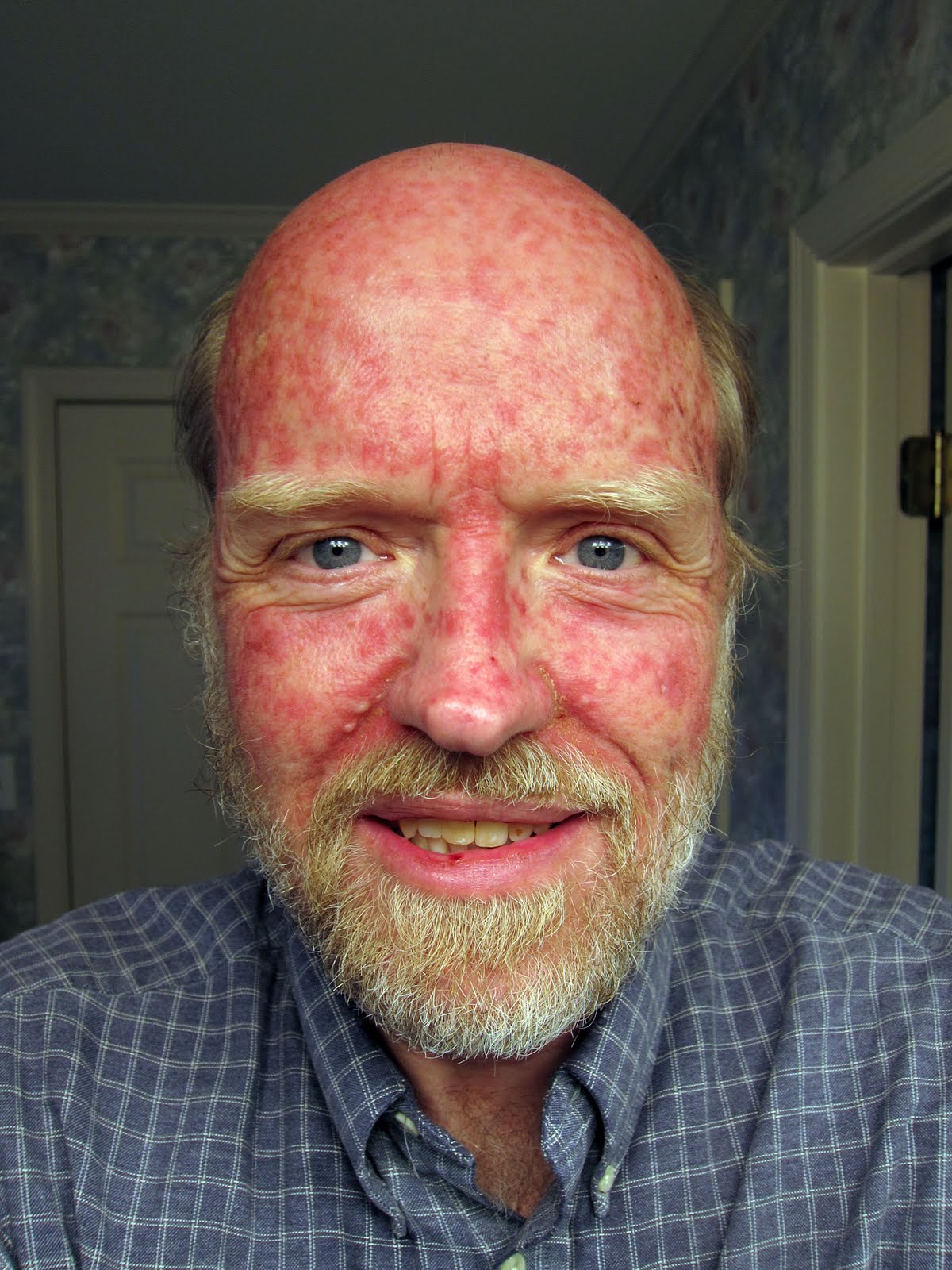 Efudex - Round Two: Day 14 - Fully Cooked!