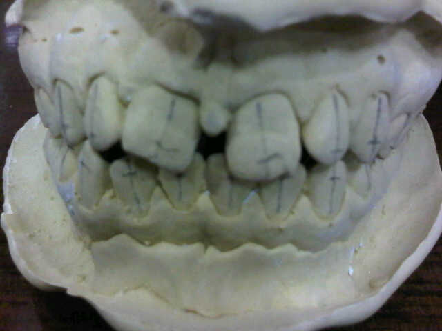 Schön Dental: Frenectomy ( Frenuloplasty, Frenotomy, Frenulectomy)