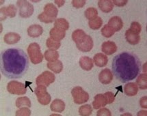 HEMATOLOGÍA: Plaquetas, Monocitos y Linfocitos