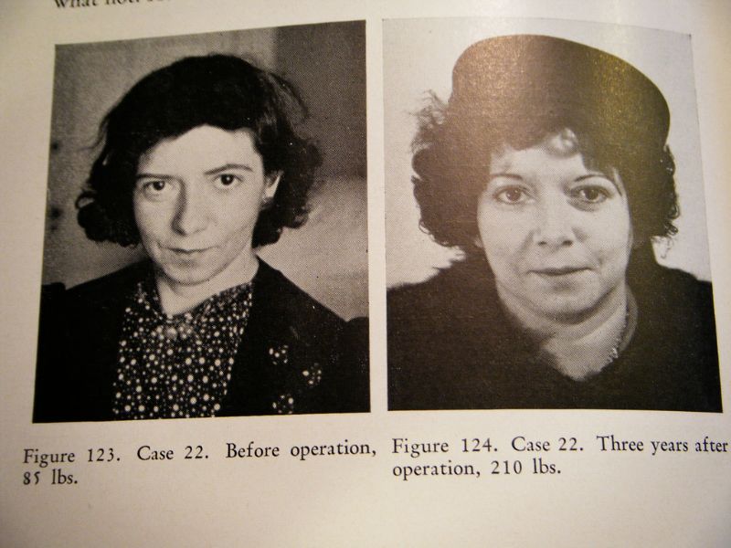 Do You Need a Lobotomy? Just Look at the Results From These Before and ...