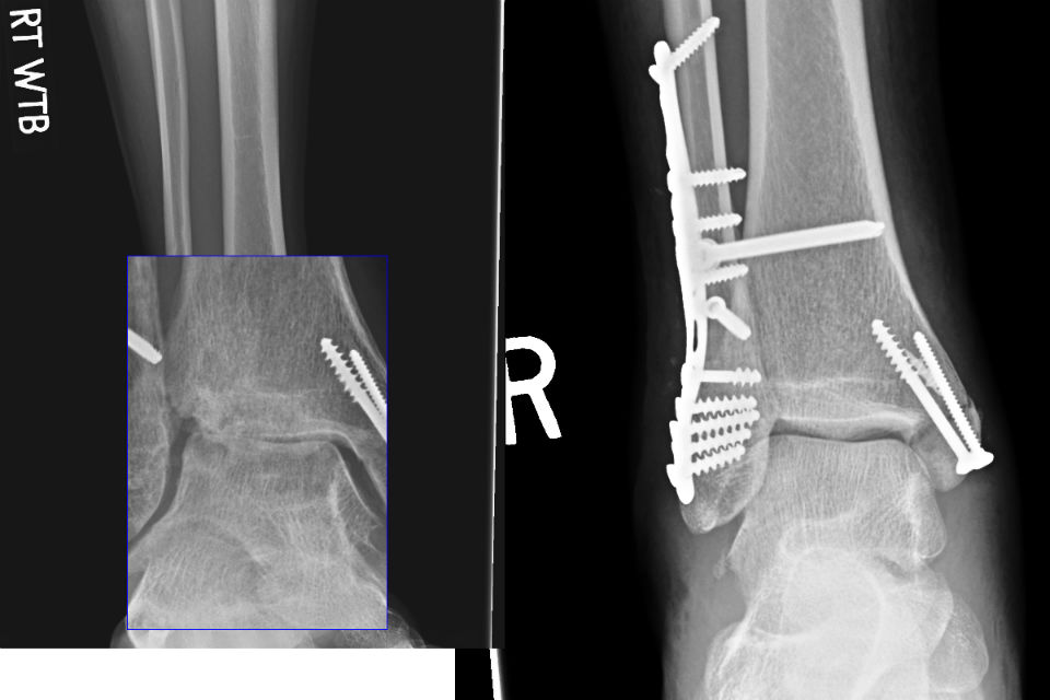Two Broken Ankles: Getting ready for surgery