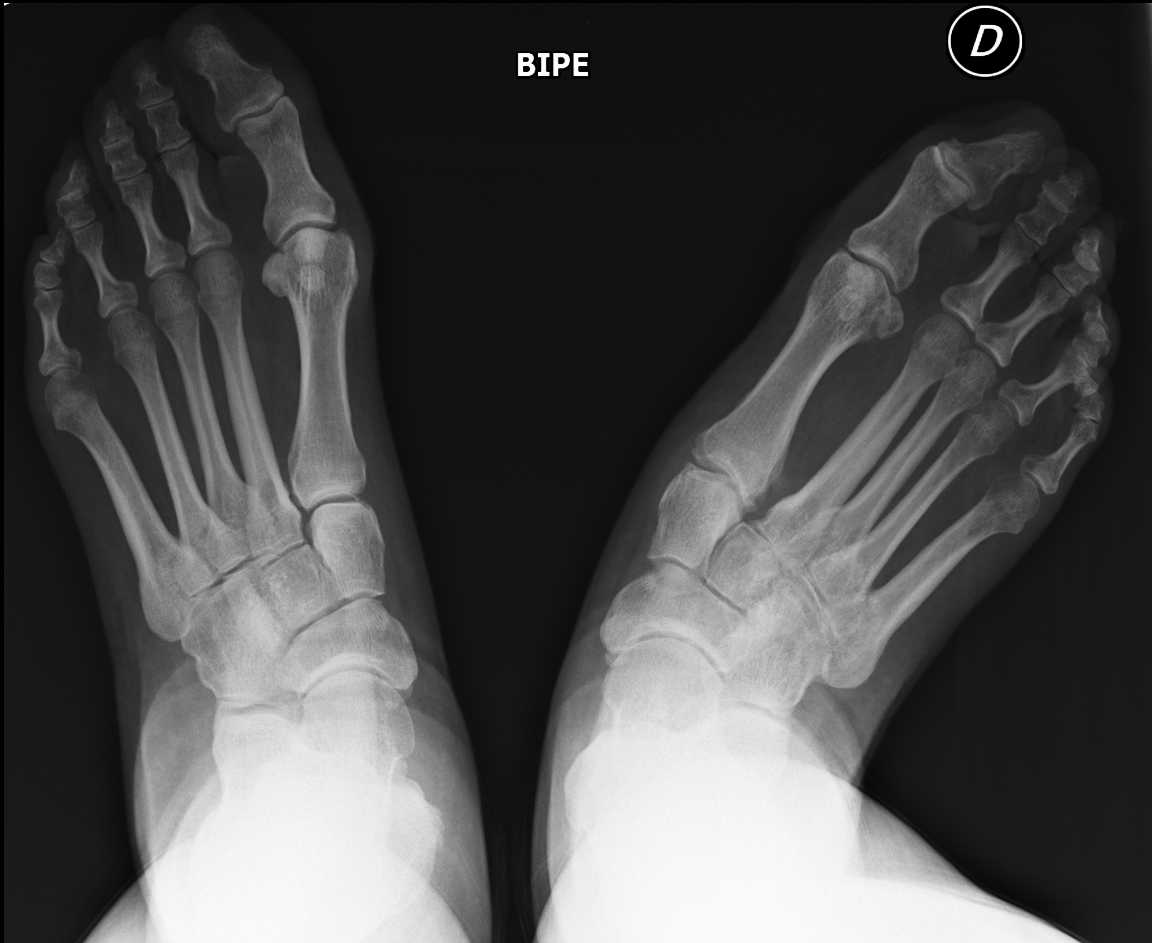 Fanáticos del pie: ATLAS DE PATOLOGÍA DEL PIE: PIE PLANO VALGO