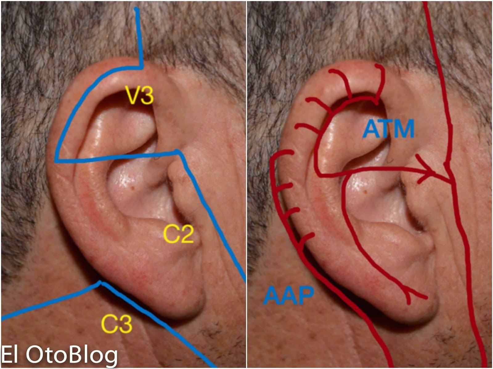 El OtoBlog: El Síndrome de la Oreja Roja