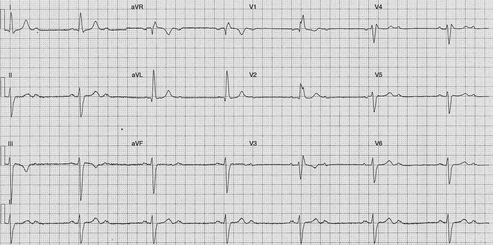 ECG of the Week: ECG of the Week - 4th May 2015 - Interpretation