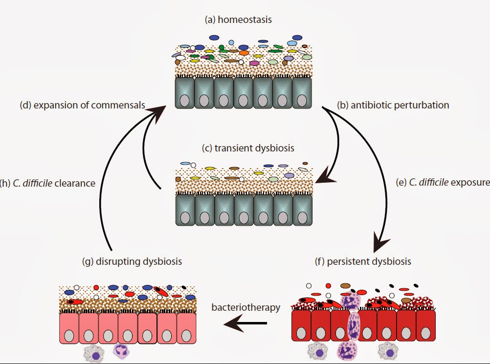 Doença de Crohn: novas perspectivas: Clostridium difficile