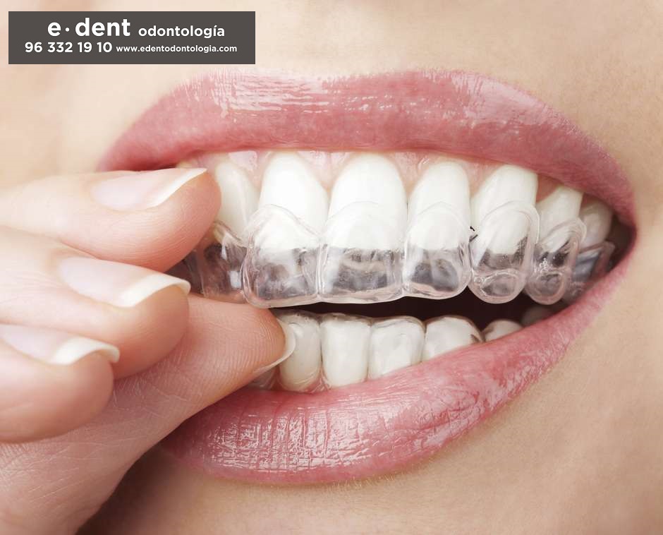 e.dent odontología: ¿Qué son y como se usan los protectores dentales?