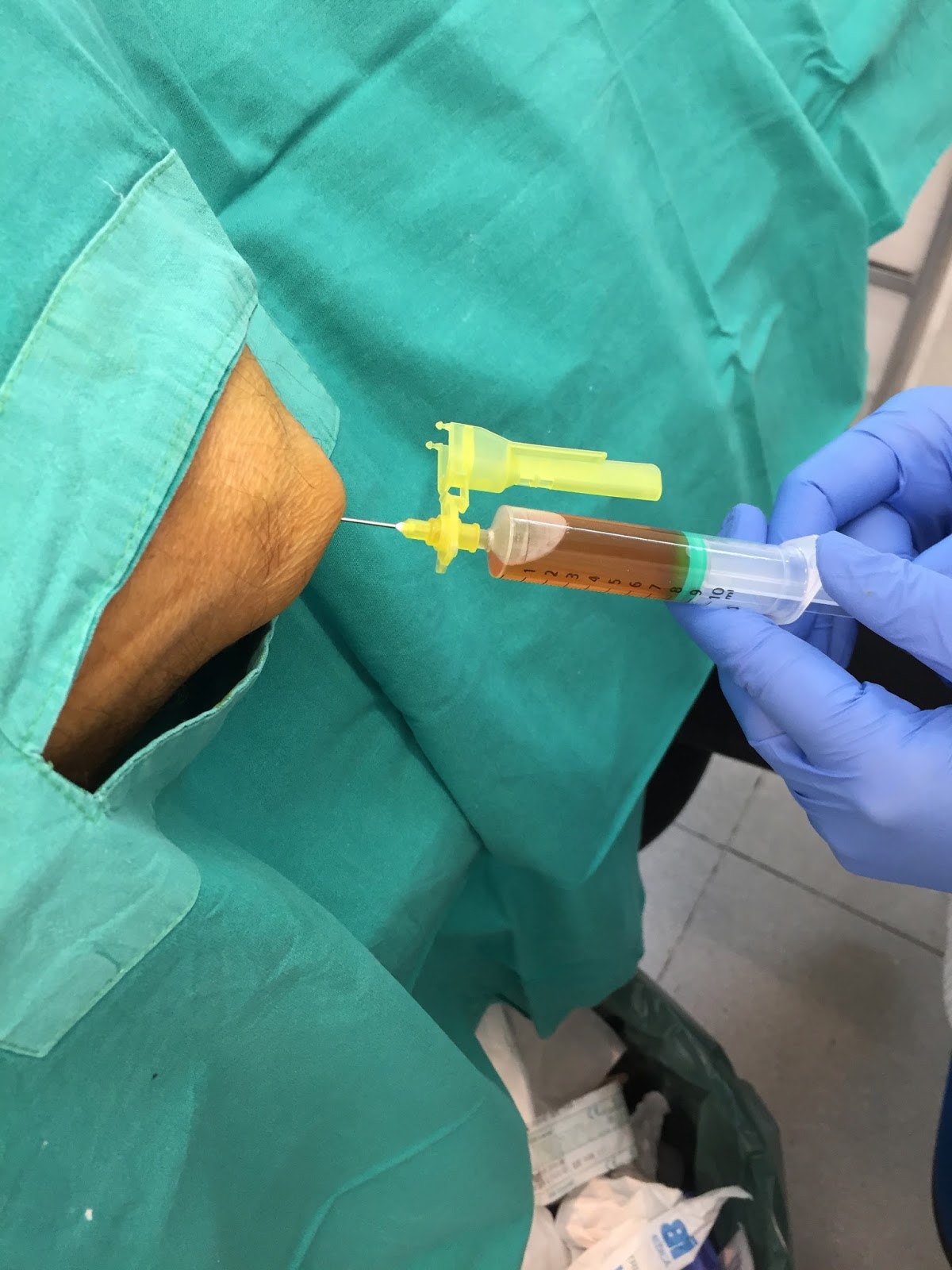 Bursitis olecraniana ¿qué hago con ella?