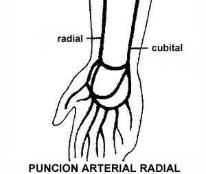 El Blog De la Enfermera: Acceso Arterial pt 2