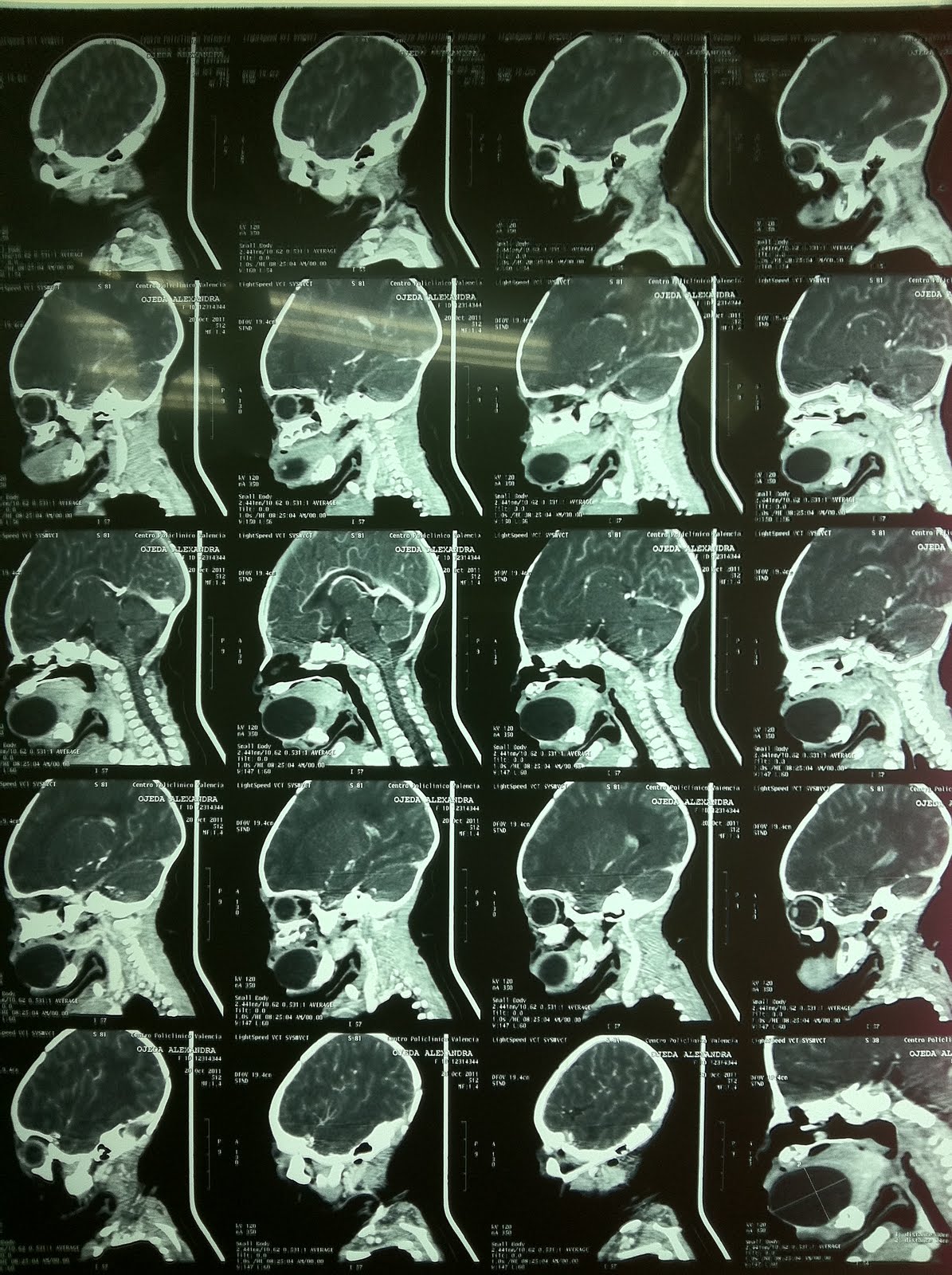Cohen Cirugia Buco Maxilofacial: Higroma Quistico de Lengua