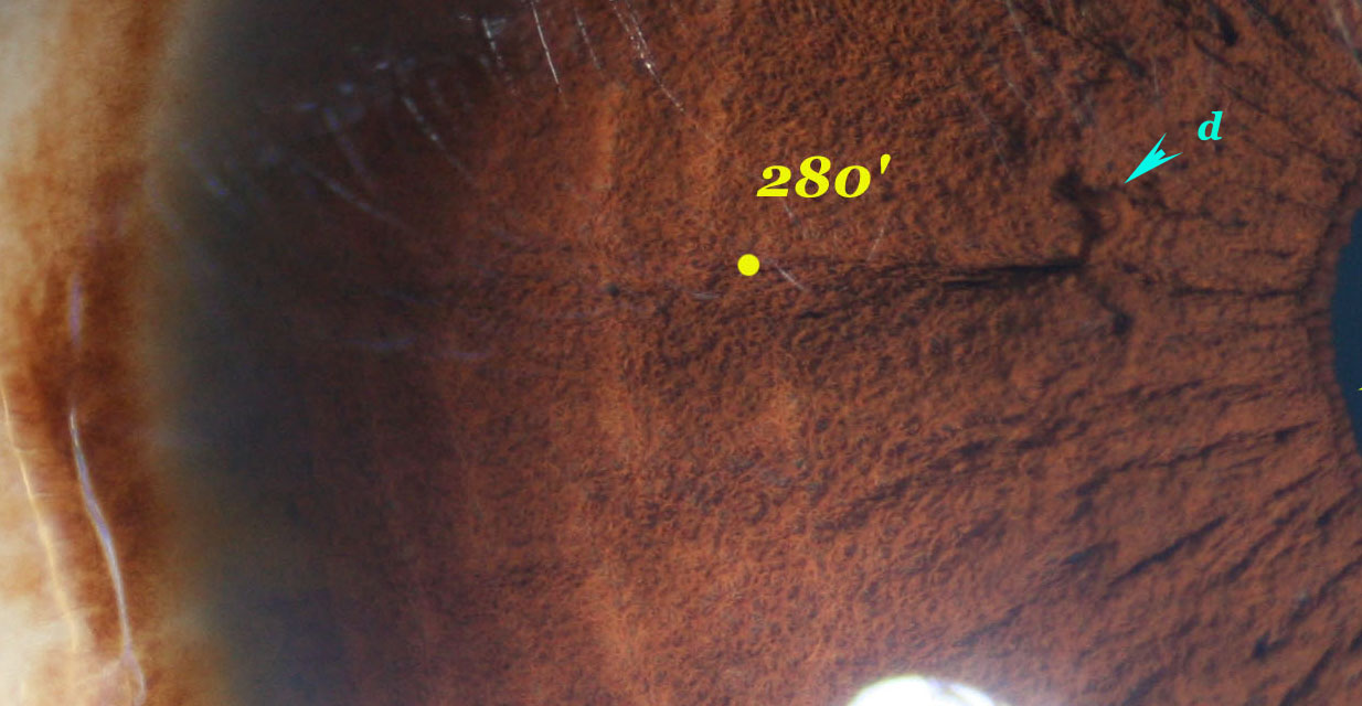 Modern & Multidimensional Iridology: Koch's Sign & Localised ...