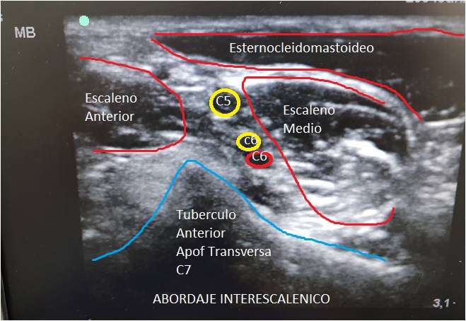 Bloqueo del Plexo Braquial