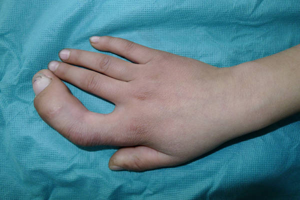 Fragmentos e Olhais: Deficiências congénitas