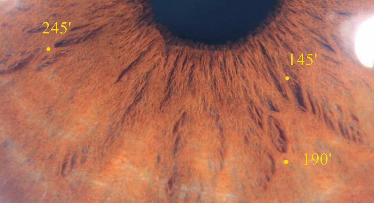 Modern & Multidimensional Iridology: The Inner Pupillary Border ...