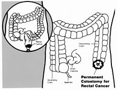 Colostomy and Ileostomy Blog: 2011