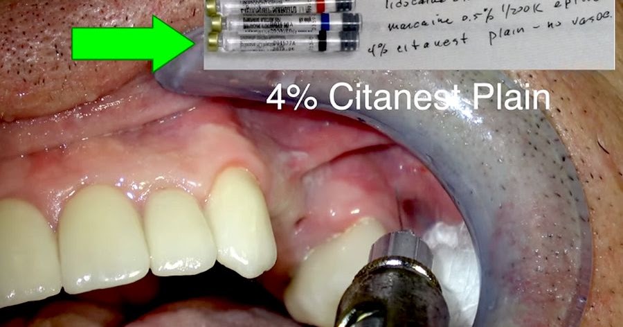 DENTAL ANESTHESIA: How to Give a Painless Injection - Steven T ...