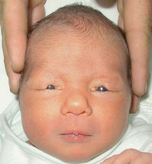 Microftalmia: ~ Heranças Teratogênicas