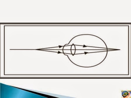 OMTEX CLASSES: Given below is a diagram showing a defect of human eye ...