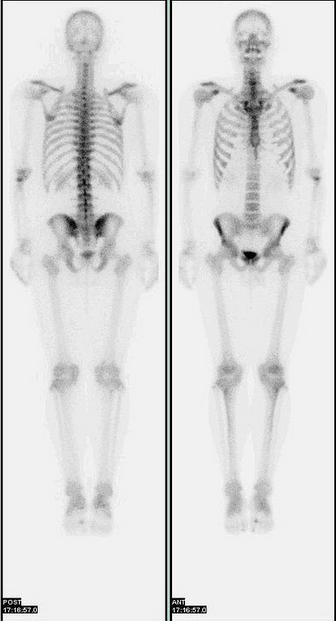 Nuclear Medicine Exams Explained - For The Patient: My Doctor Has ...