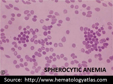 Lab Atlas: Spherocytic Anemia