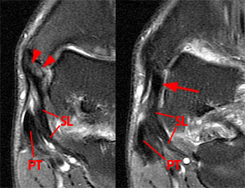 Deltoid Ligament Mri