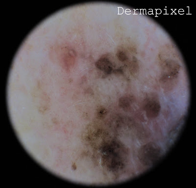 Dermapixel: junio 2012