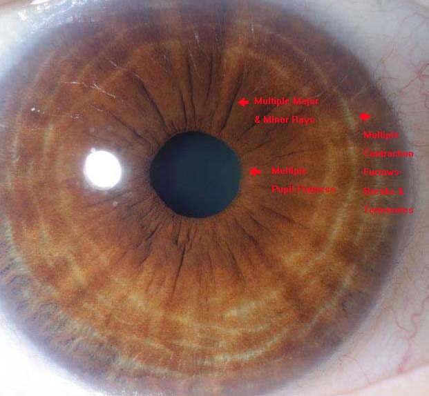 Modern & Multidimensional Iridology: Pupil Applanations, Schwalbe's ...