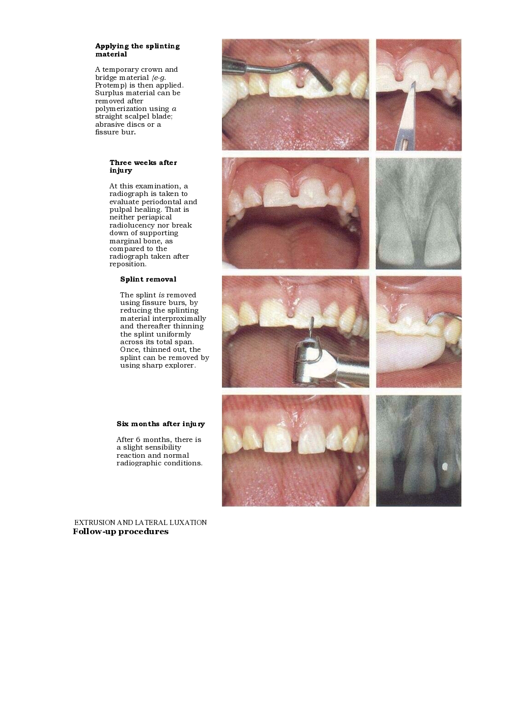 DOs and DONTs in DENTISTRY: CONCUSSION ,SUBLUXATION,EXTRUSION ,LATERAL ...