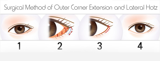 Eyelid Surgery Legend Dr. Kim Byung Gun: [BK Plastic Surgery Hospital ...