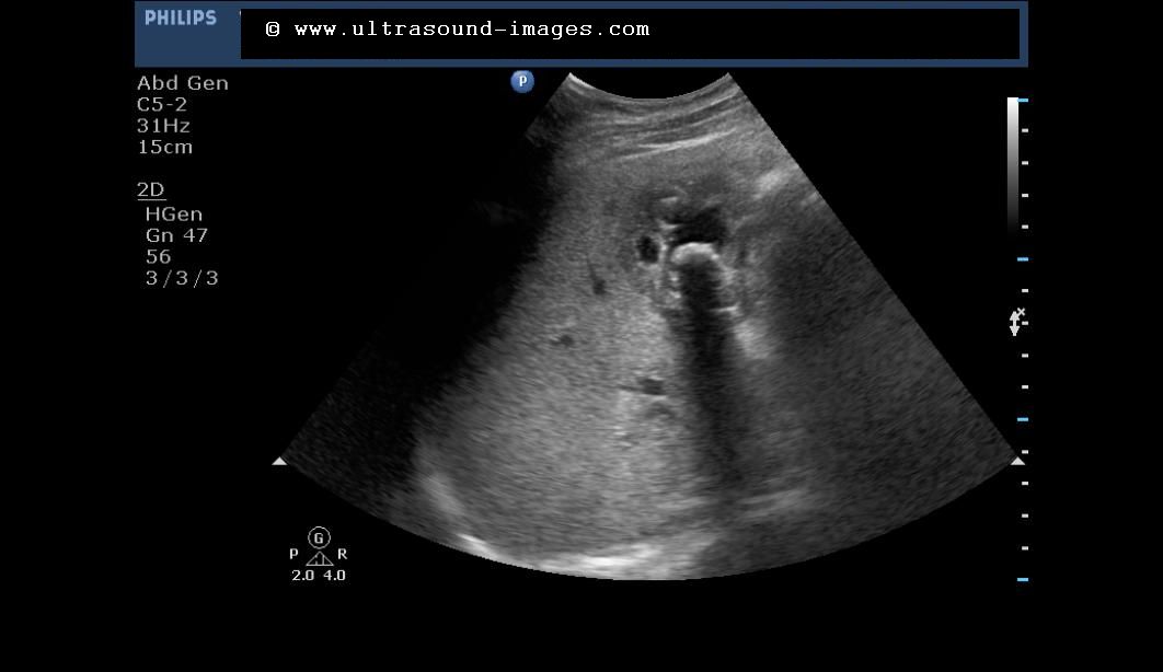 cochinblogs: Ultrasound imaging of gallbladder mass