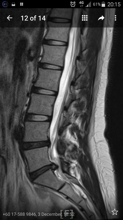 Kesakitan Anda Keutamaan Kami: PLDD Laser Injection For Slipped Disc