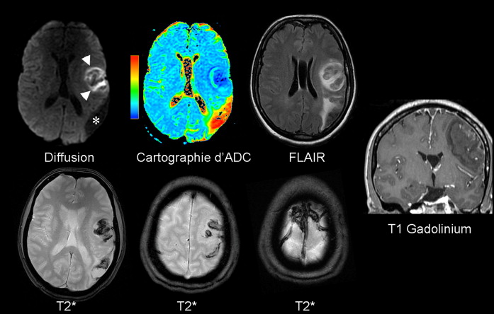 Les accidents vasculaires cérébraux
