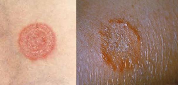 Tips Pengobatan dan Pencegahan Penyakit Kurap ~ Berbagi Informasi