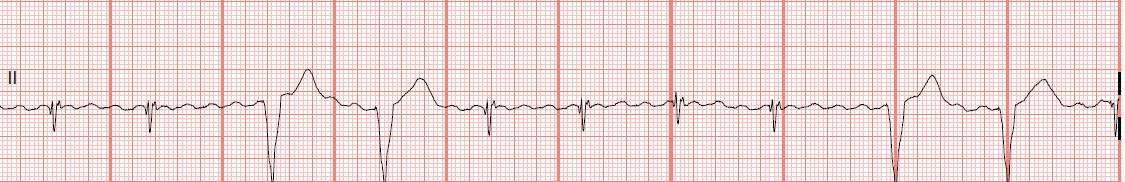 EKG Rhythm Strips 66