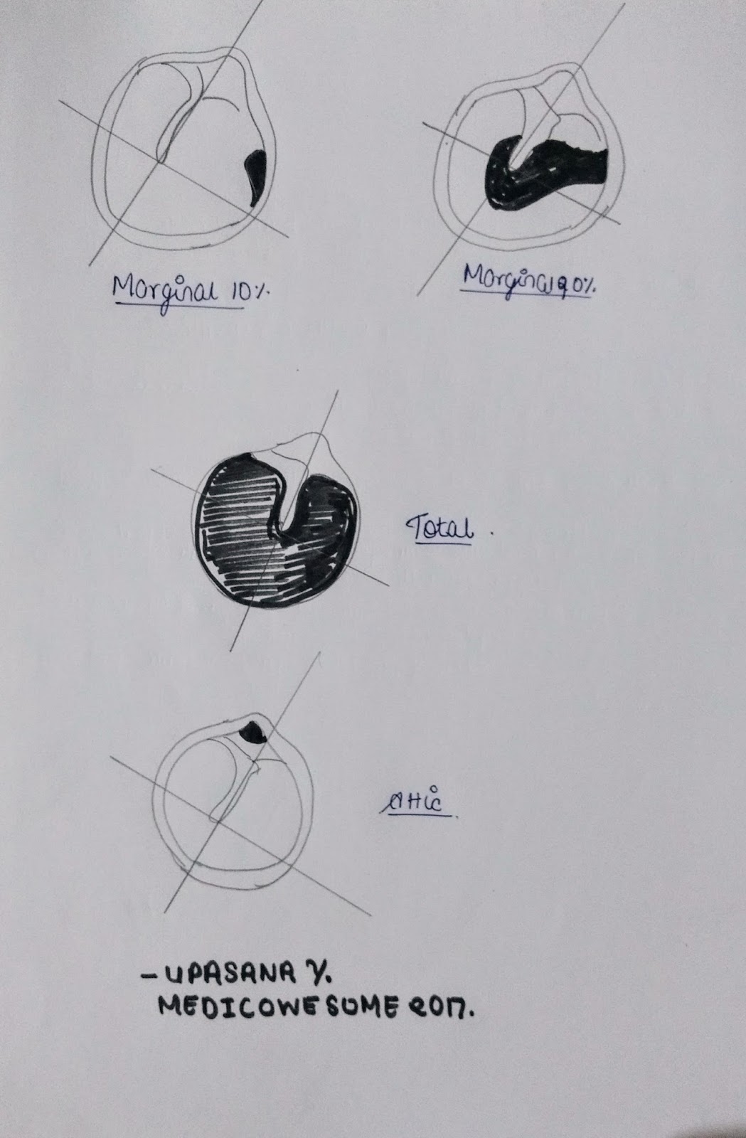 Medicowesome: Types of tympanic membrane perforation