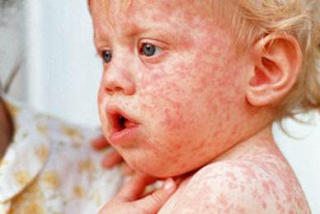 PENYAKIT GABAGEN: Penyakit gabag