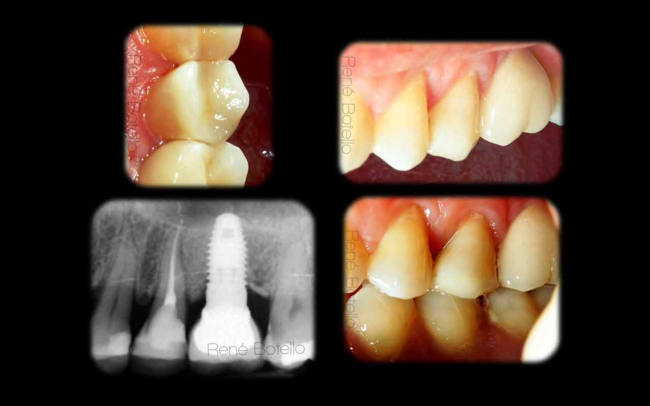 Máster en Odontología Restauradora y Endodoncia: Tratamiento de ...