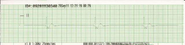 EKG Rhythm Strips 14: Junctional Rhythms