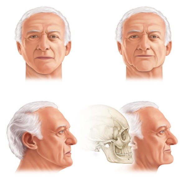 alademosca il·lustració: "Col·lapse facial"